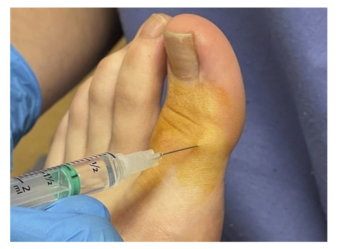 hypodermic affection