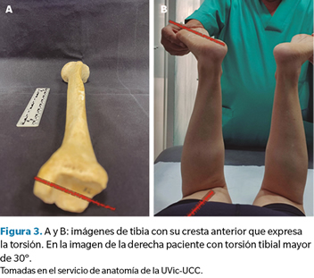 Reflexiones sobre la torsión tibial externa y repercusiones en la ...